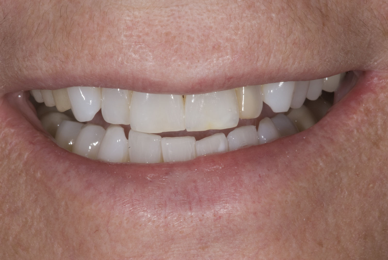 Porcelain Laminate Veneers - TM