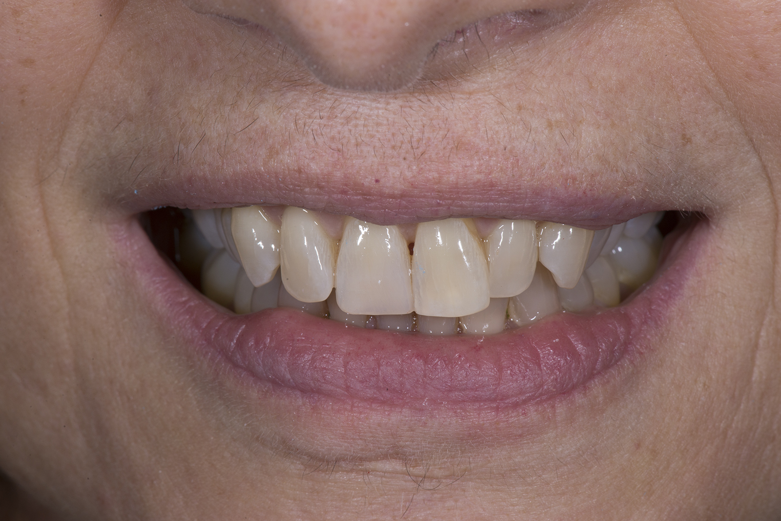 Composite fillings and composite veneers - TM