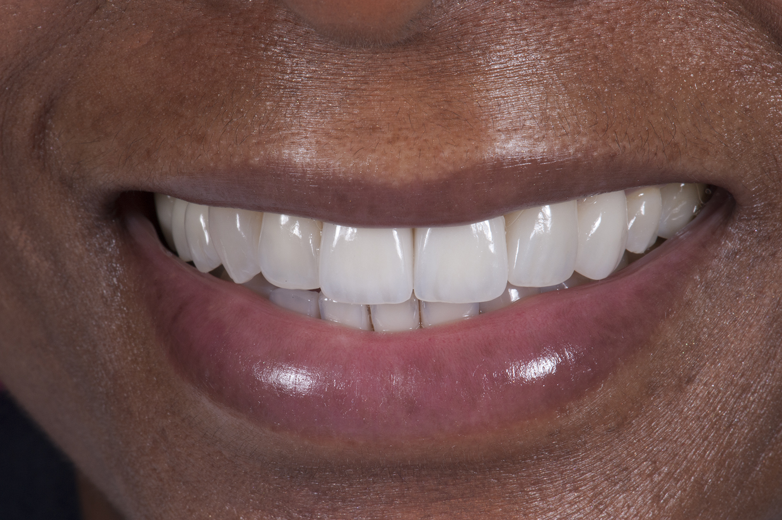 Porcelain Laminate Veneers - TM