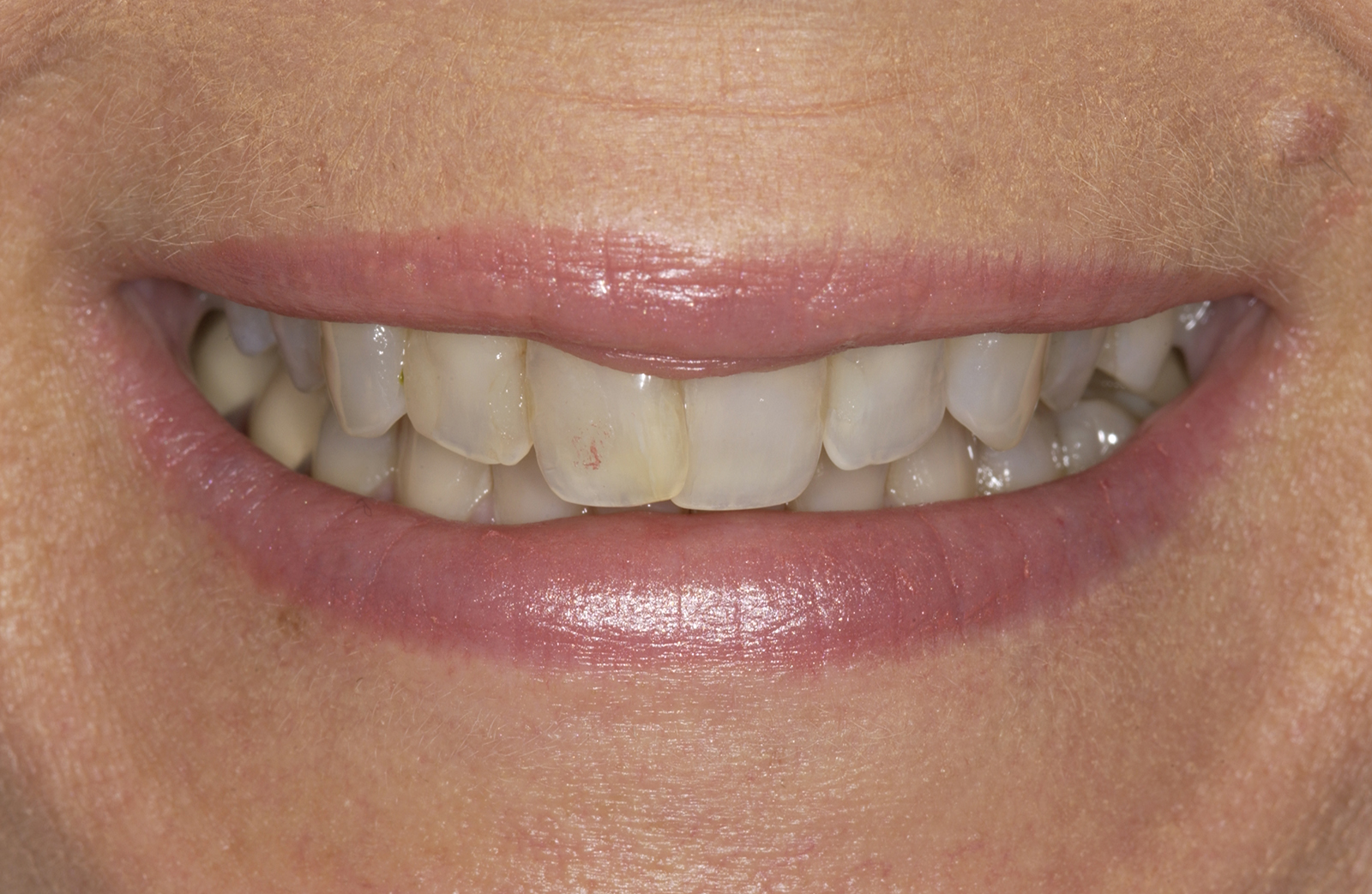 Porcelain Laminate Veneers - TM